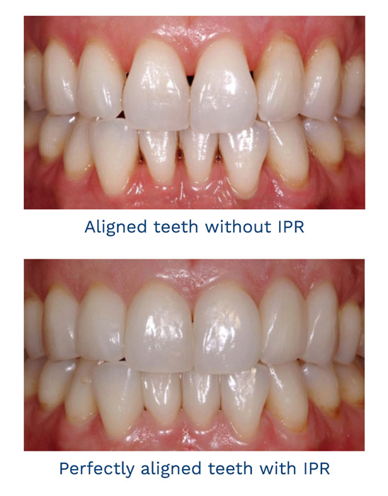 Is IPR Healthy For Your Teeth? | Evenly®